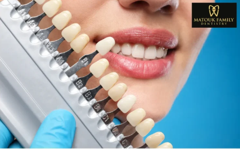 Houston Cosmetic Dentist – A Natural Smile Upgrade in Sagemont - Matouk ...